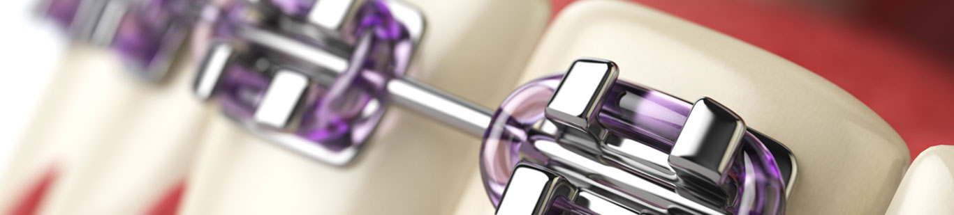 Types of Braces | Modern Braces for Teeth | Modern Orthodontics